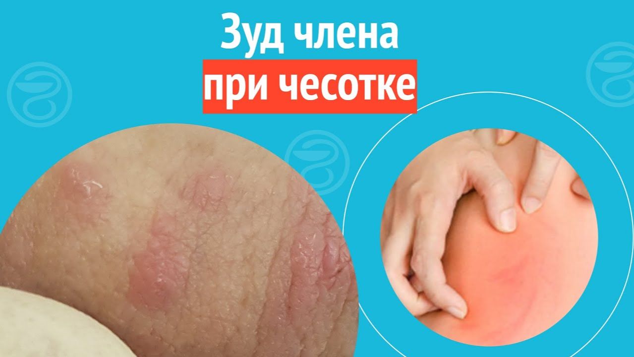 👉 Зуд члена при чесотке. Клинический случай №1477