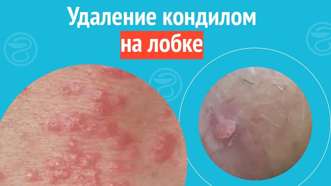 ✅ Удаление кондилом на лобке. Клинический случай №1487