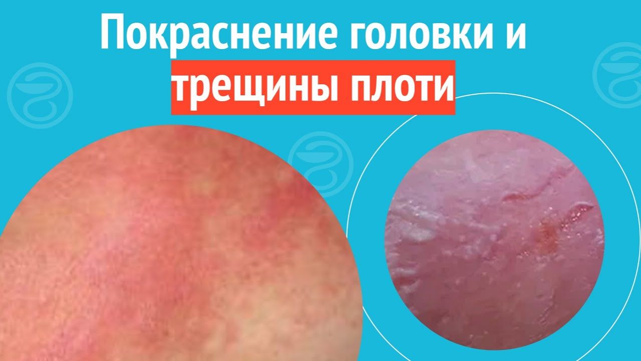 😡 Покраснение головки и трещины плоти. Клинический случай №1501