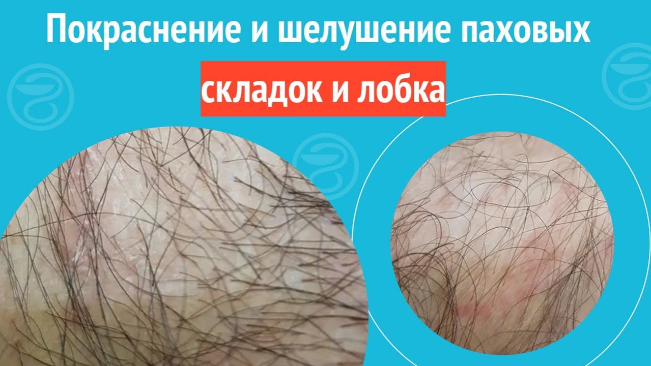 😐 Покраснение и шелушение паховых складок и лобка. Клинический случай №1469