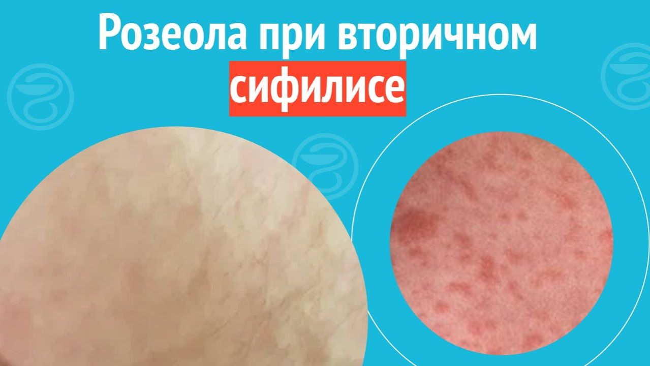 ➡️ Розеола при вторичном сифилисе. Клинический случай №1479