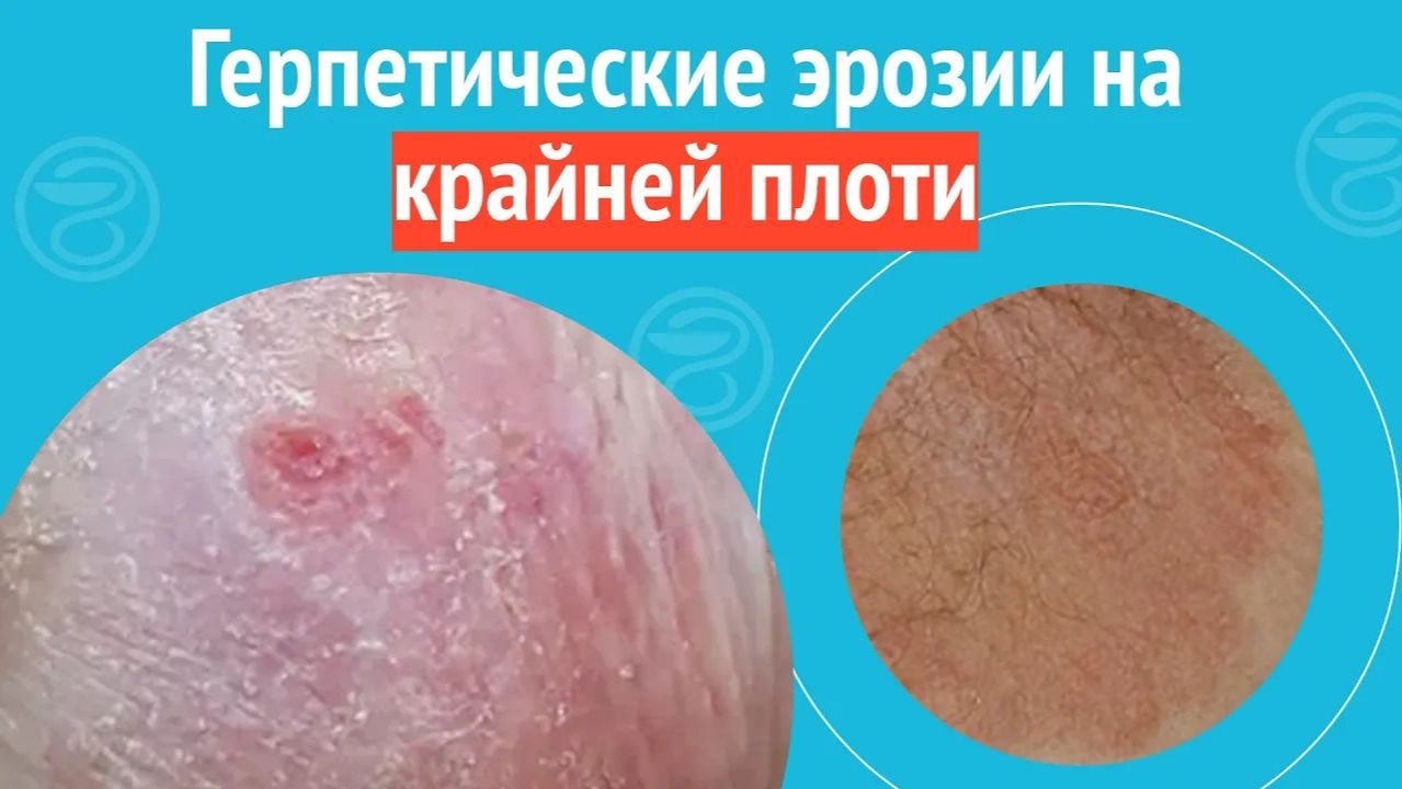 🙄 Герпетические эрозии на крайней плоти. Клинический случай №1495