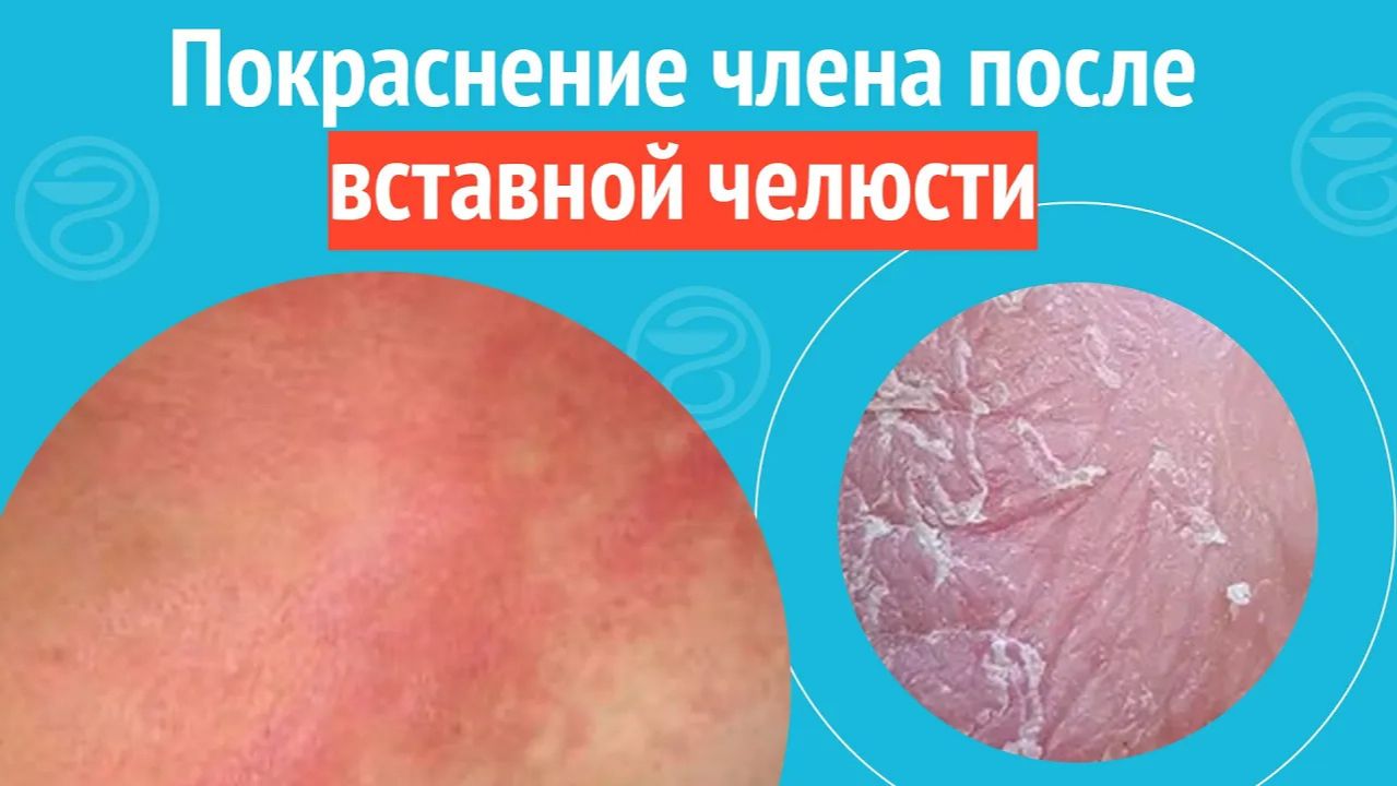 😡 Покраснение члена после вставной челюсти. Клинический случай №1484