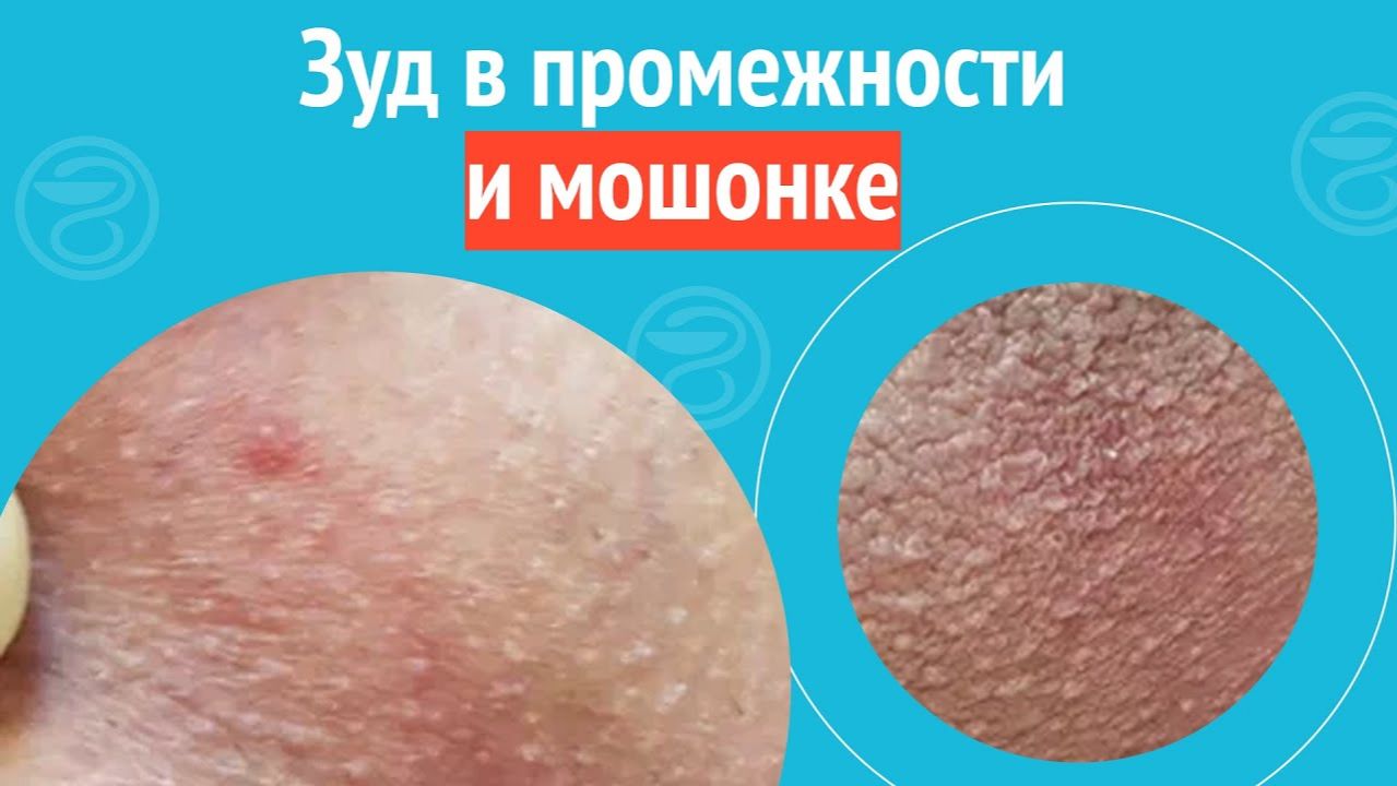 ➡️ Зуд в промежности и мошонке. Клинический случай №1472