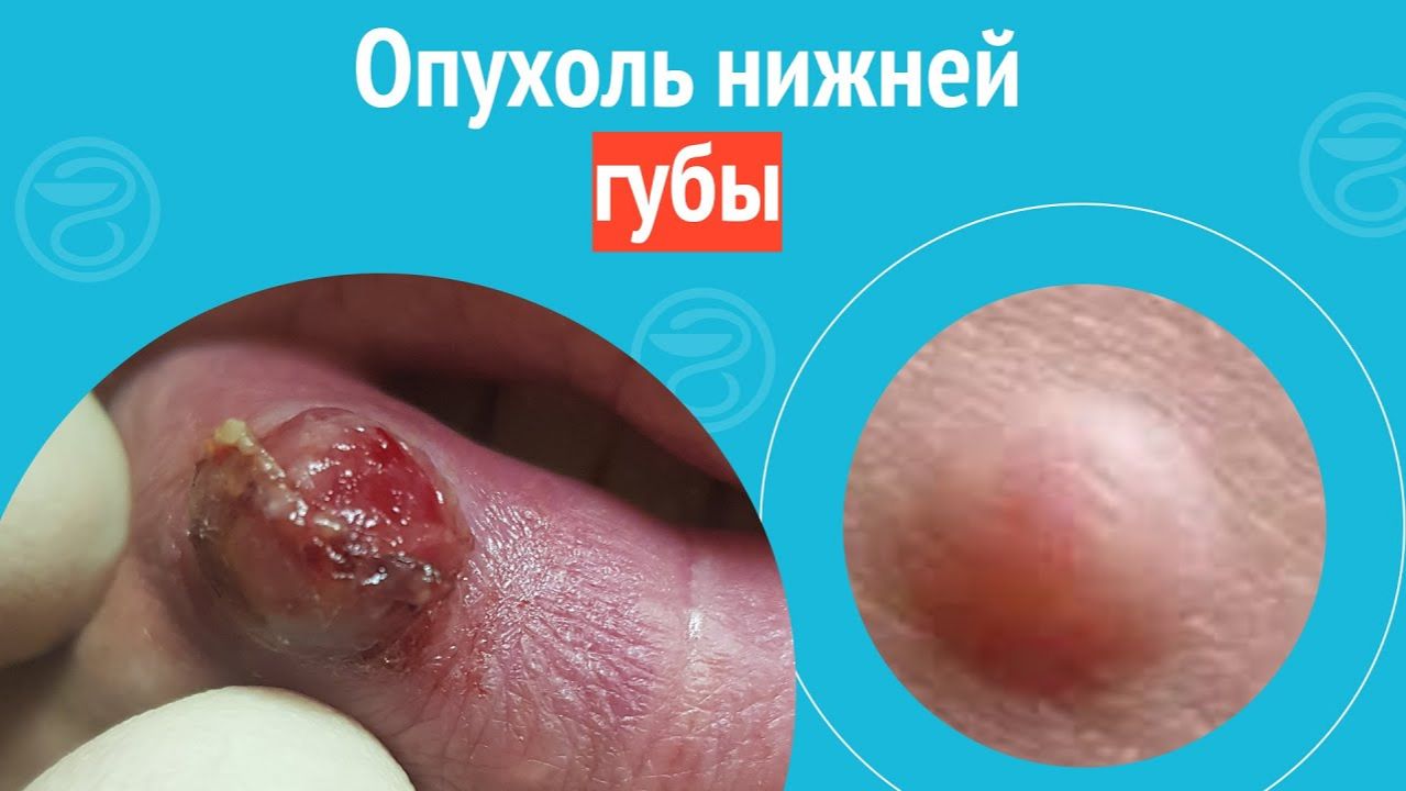 👄 Опухоль нижней губы. Клинический случай №1473