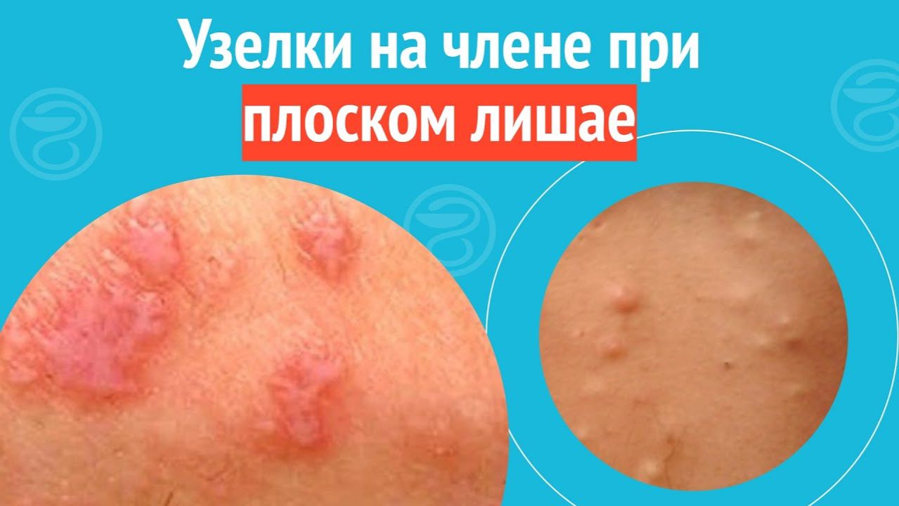 🥺 Узелки на члене при плоском лишае. Клинический случай №1489