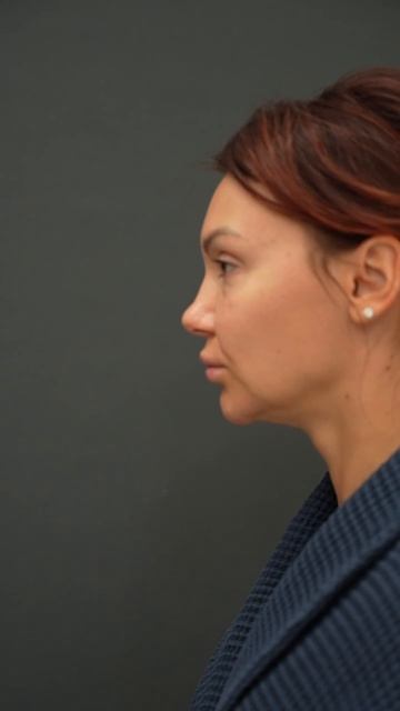 #SMAS-подтяжка _лица в молодом возрасте