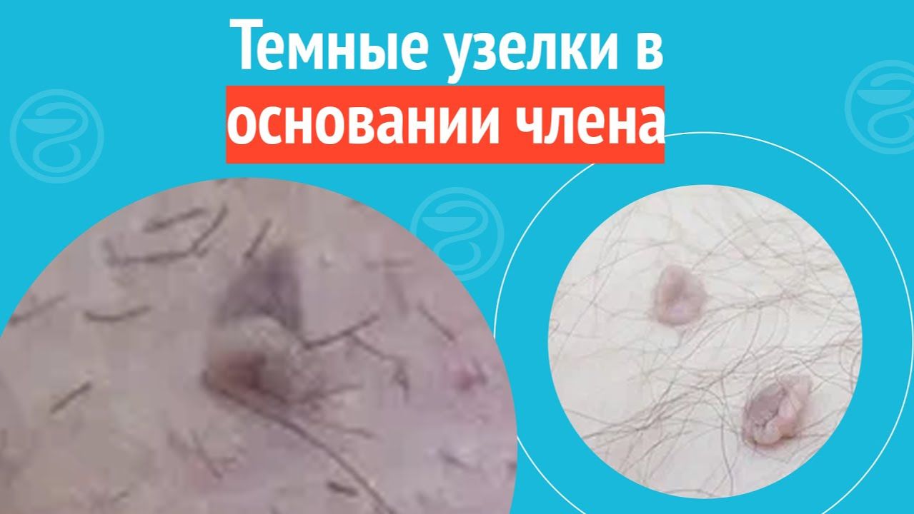👉 Темные узелки в основании члена. Клинический случай № 1712