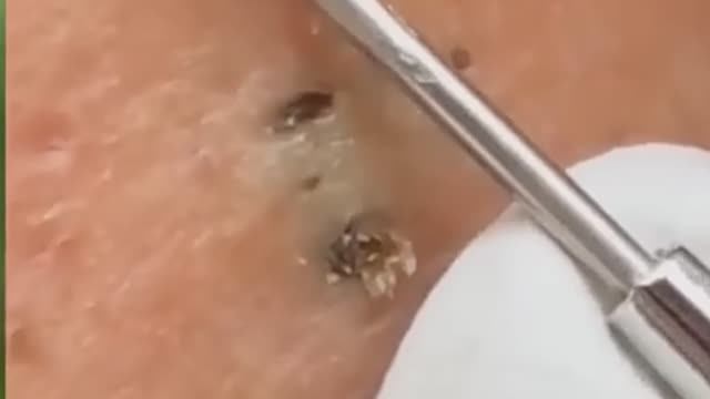 Выдавливание прыщей #черныеточки #чисткалица  #прыщи