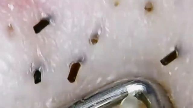 Выдавливание чёрных точек. #черныеточки #чисткалица #проблемнаякожа