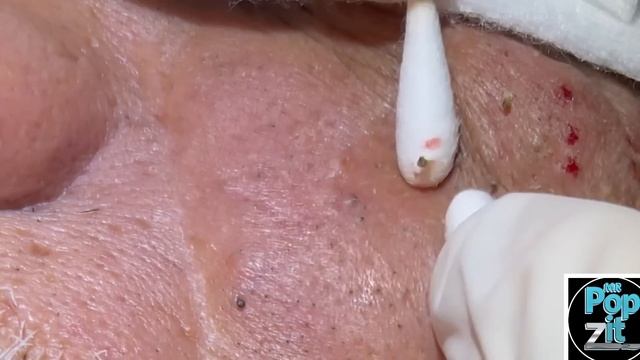 Множественные черные и белые угри, сгруппированные вместе. Синдром Фавра-Ракушо #угри