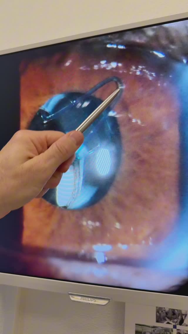 Синдром Марфана. ПОВТОРНАЯ ОПЕРАЦИЯ ЧЕРЕЗ 16 ЛЕТ ЗАМЕНА ИОЛ В КАПСУЛЬНЫЙ МЕШОКПРИ СИНДРОМЕ МАРФАНА.