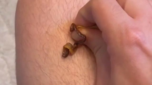 ПРЫЩИ 😱 Огромные прыщи 😯 Релакс с акне _ Выдавливание прыщей _ Черная точка #Прыщи