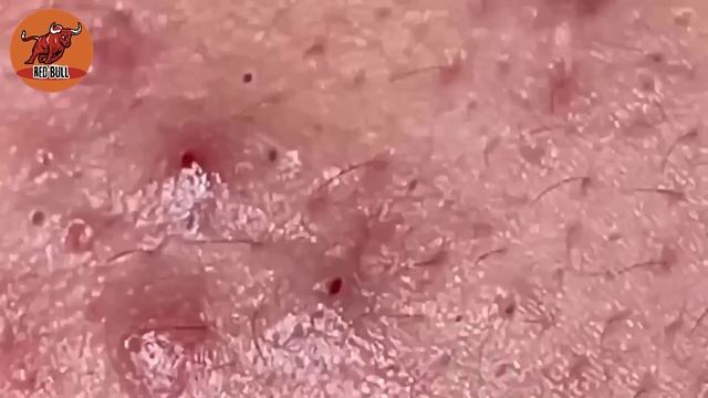 Глубокое очищение кожи. Успокаивающая косметическая процедура для снятия стресса #𝟗𝟎𝟎𝟑𝟓𝟖