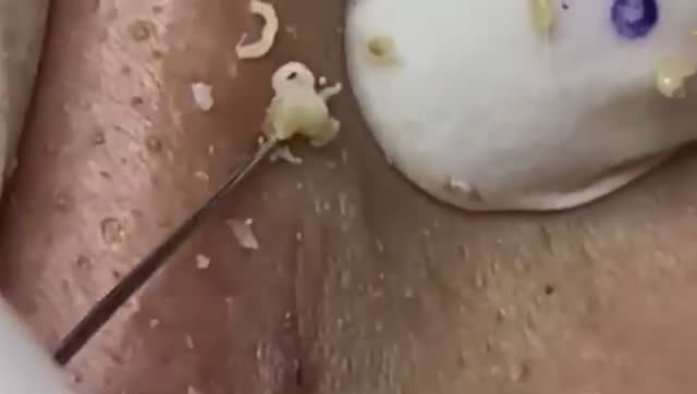 Прыщи _ Огромные прыщи _ Релакс с акне _ Выдавливание прыщей _ Черная точка #Прыщи_9