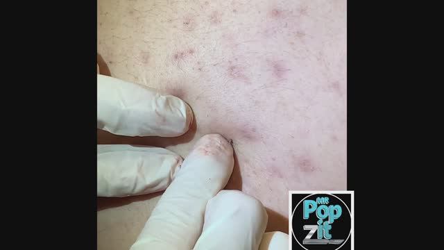 Множественное удаление чёрных точек. Мощное выдавливание. Вскрытие кисты. #черныеточки #киста