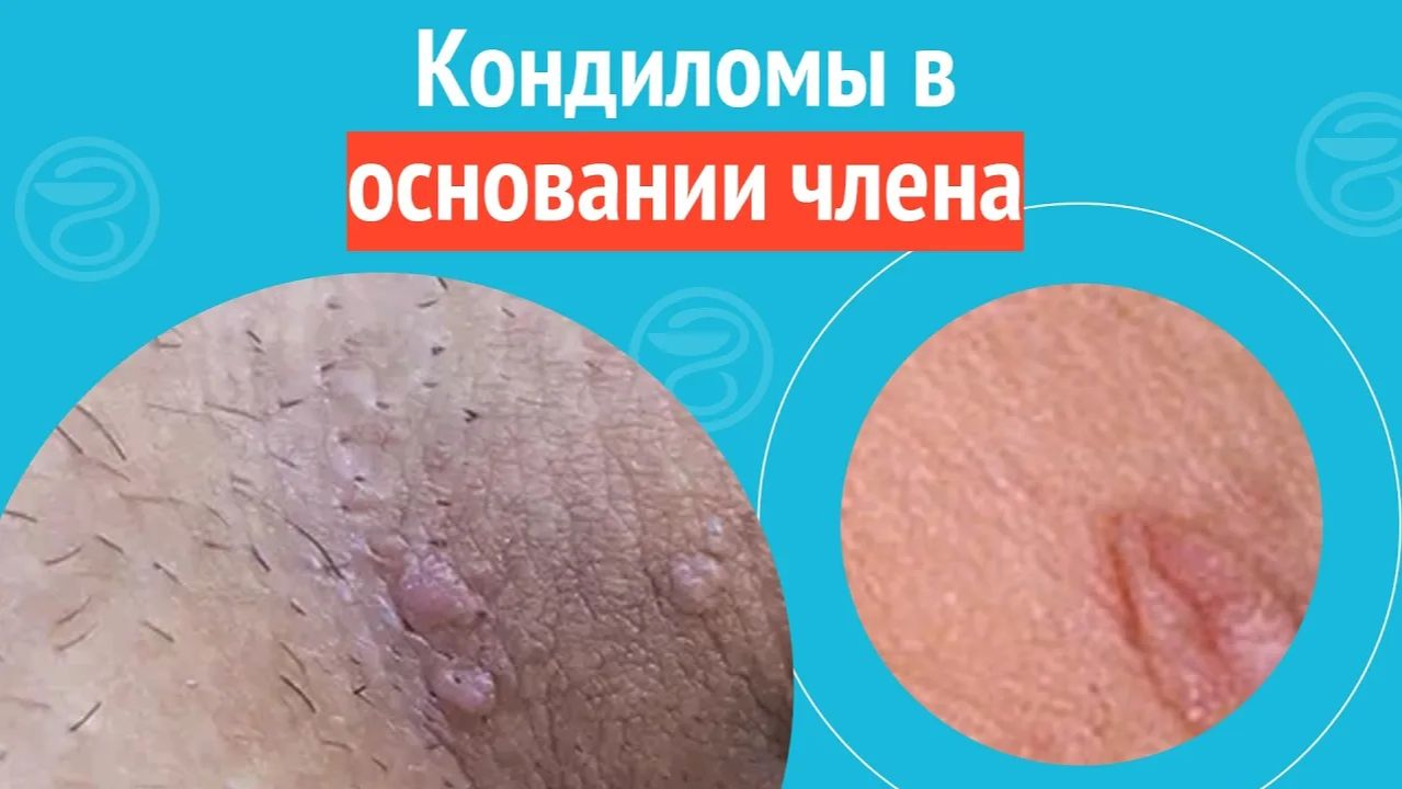 👉 Кондиломы в основании члена. Клинический случай №1462