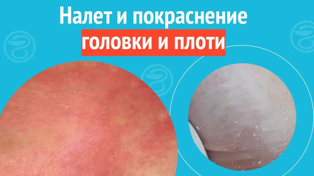 😯 Склероз головки и плоти. Клинический случай №1460