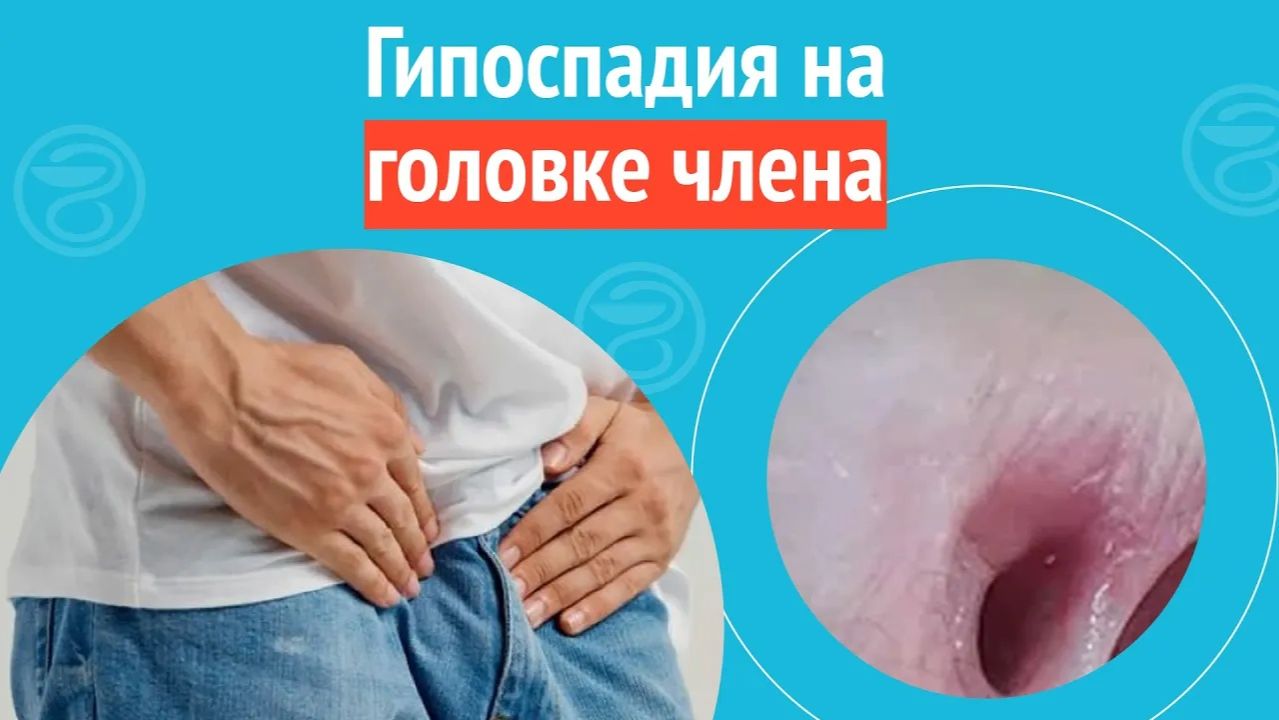 ➡️ Гипоспадия на головке члена. Клинический случай №1456