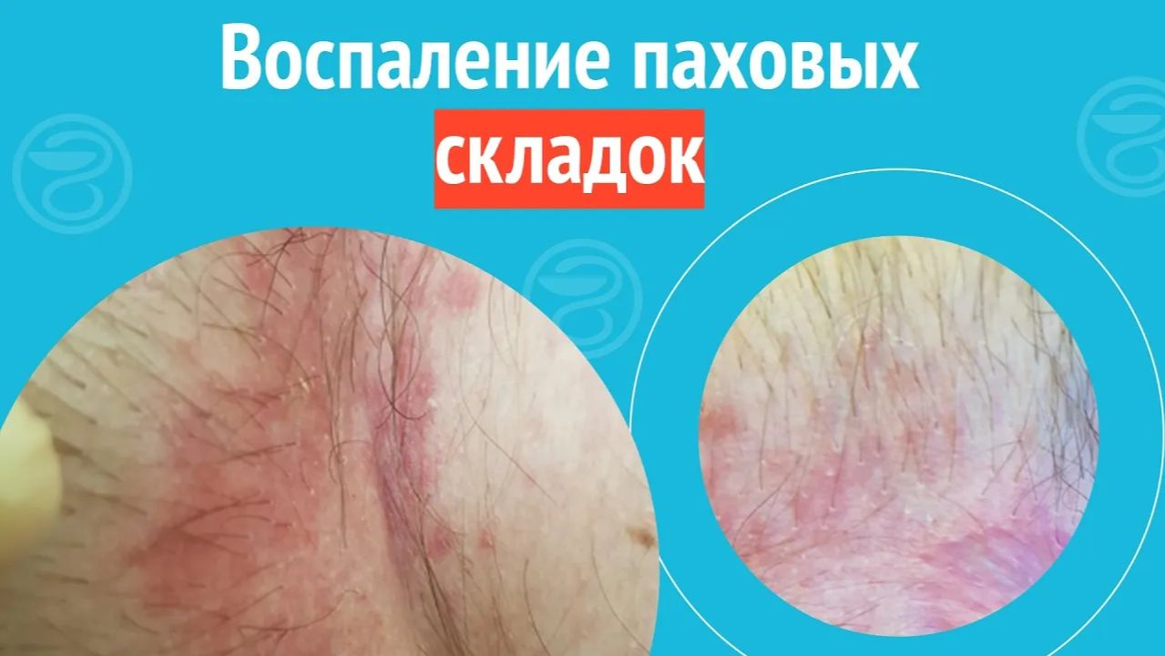 😨 Воспаление паховых складок. Клинический случай №1466