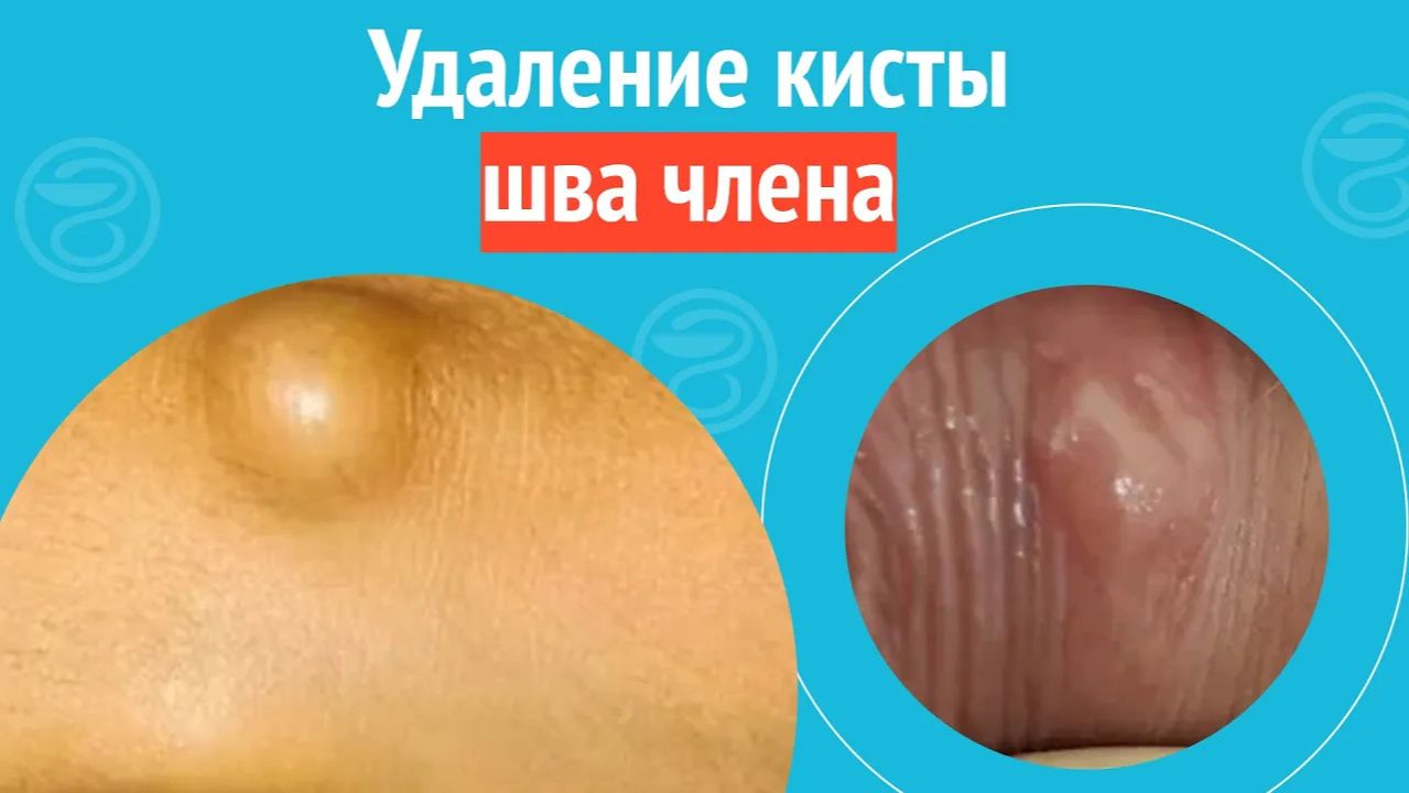 ▶️ Удаление кисты шва члена. Клинический случай №1467