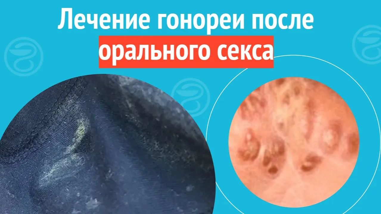 🩺 Лечение гонореи после орального секса. Клинический случай №1448