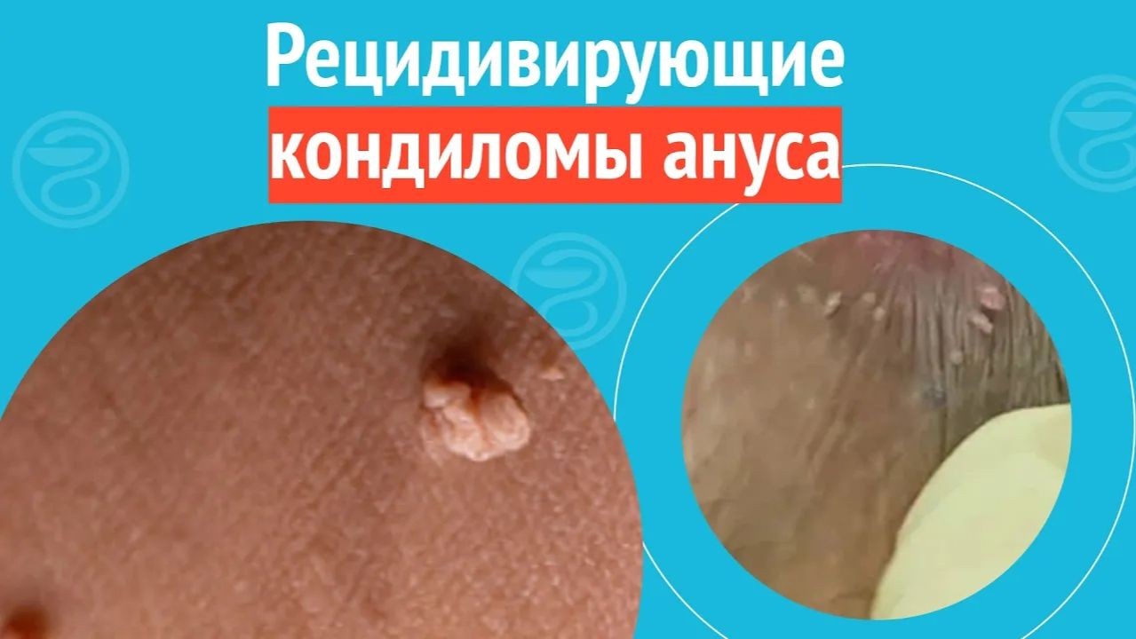 🥺 Рецидивирующие кондиломы ануса. Клинический случай №1452