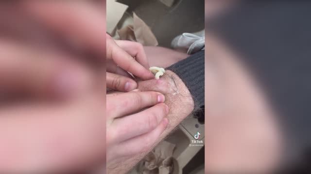 Лучшая подборка видео: Выдавливание прыщей, кист, удаление черных точек Часть 7