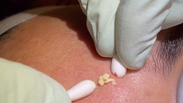 Удаление белых угрей/фолликулярных кист. Возможная стеатоцистома. #белыеугри #стеатоцистома