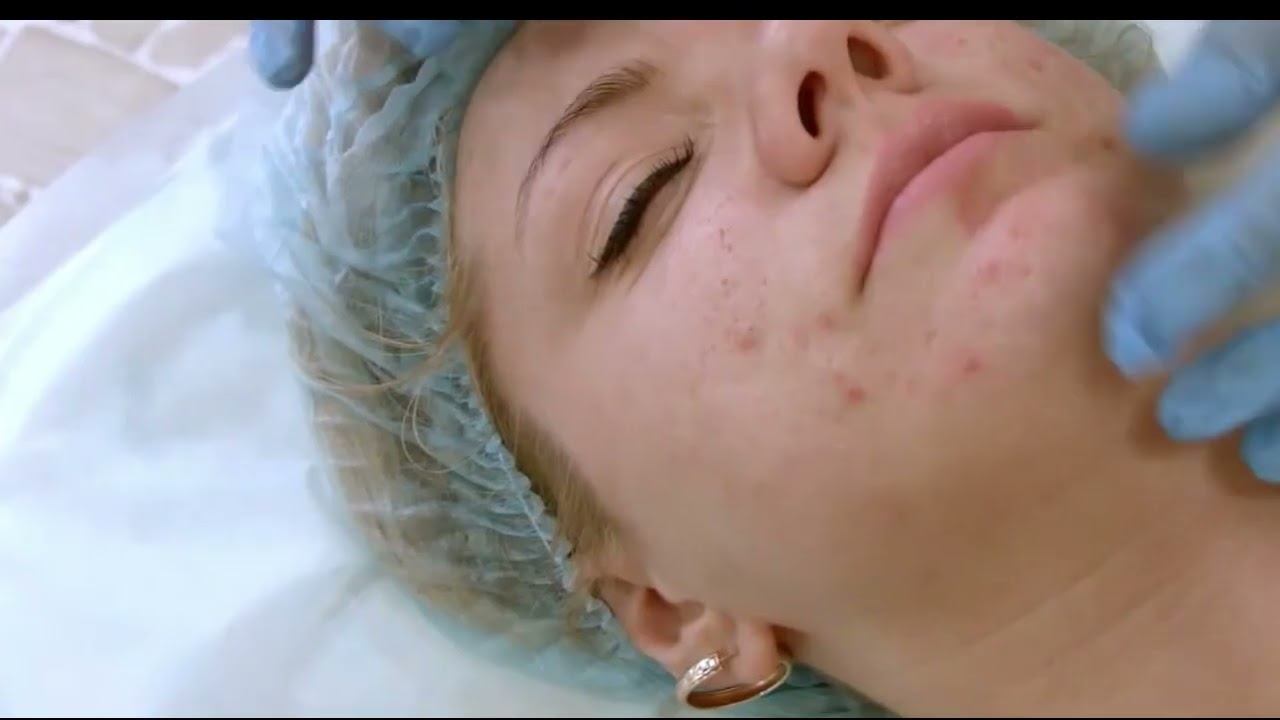 Как ухаживать за кожей лица и шеи: 5 советов (Удаление камедонов (ультразвуковая  чистка30 мин)