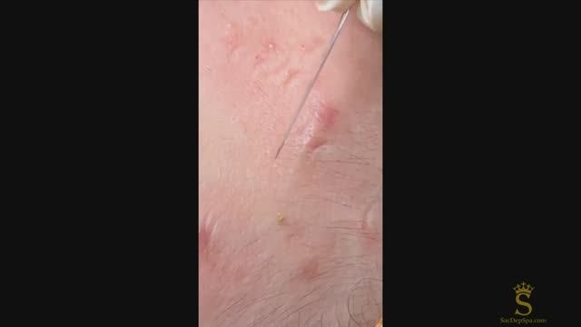 Гладкая кожа? Не тут-то было! Столько скрытых прыщей! #скрытыепрыщи #подкожныепрыщи #чисткалица