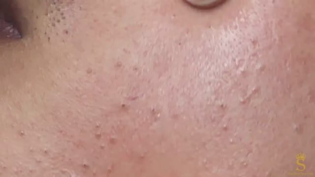 Удаление чёрных точек. Получи удовольствие от процесса! #черныеточки #удовлетворение #выдавливание