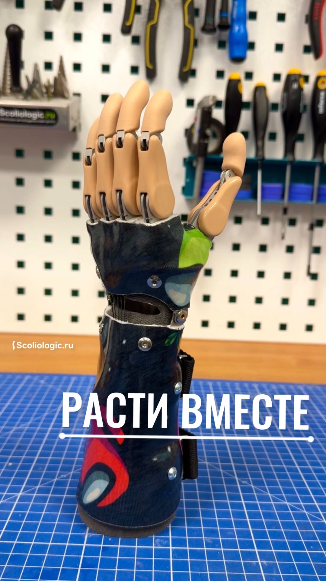 Пятый протез руки для 6-летнего мальчика