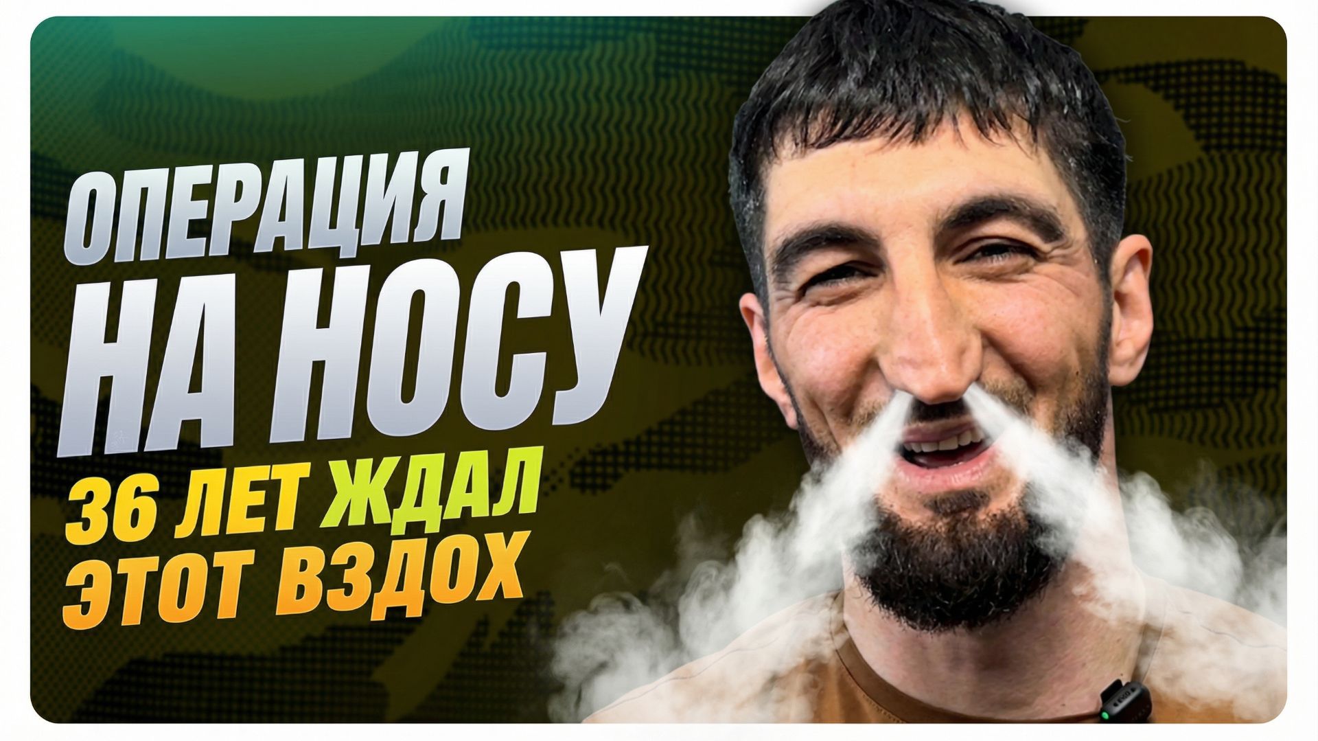 Ринопластика носа с горбинкой в Махачкале: результат через 10 дней | Али Раджабович