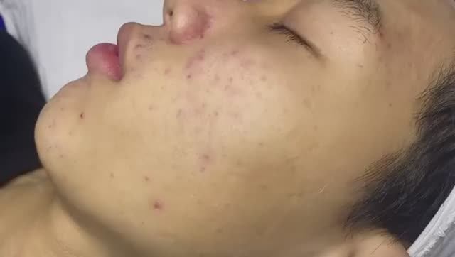 Удаление прыщей. Расслабляющий видеоролик #112. #прыщи #угри #угреваясыпь #удалениепрыщей