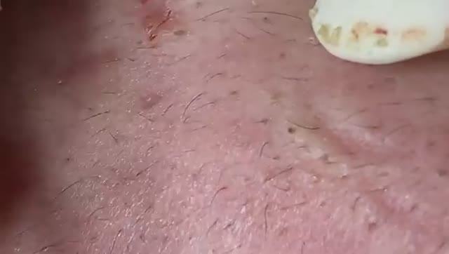 Удаление акне. асмр прыщи. Для расслабления #113. #акне #постакне #механическаячистка