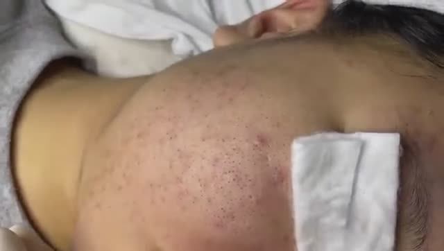 Выдавливание прыщей. Новое видео для расслабления #114. #прыщи #угри #угреваясыпь #удалениепрыщей