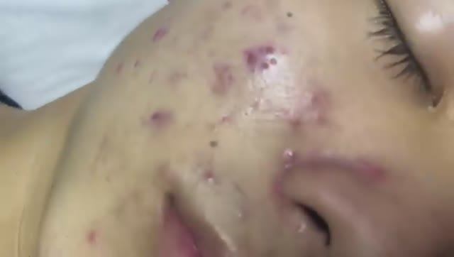 Удаление угрей и прыщей. Расслабляющий видеоролик #111. #прыщи #угри #угреваясыпь #удалениепрыщей