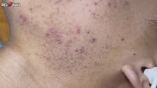 Прыщ-хамелеон. Казался простым, но оказался... #𝟗𝟎𝟎𝟑𝟕𝟑