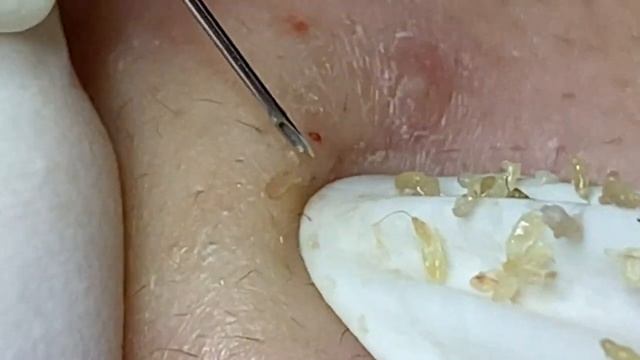 Relax Acne 001 • АСМР • Loan Nguyen collection