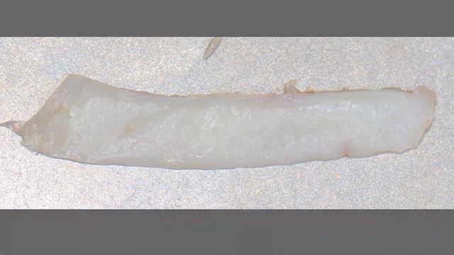 Хирургическое лечение рецессии десны 1.10