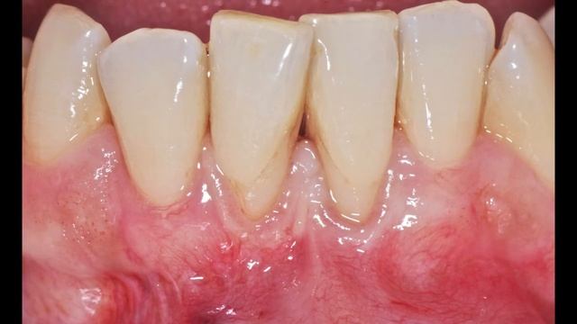 Хирургическое лечение рецессии десны 1.8