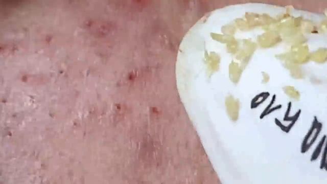 Relax Acne 005 • АСМР • Loan Nguyen collection