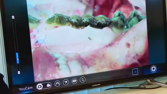 Лечение рецессий десны 10.11.17. Носова Мария. Эпизод 22