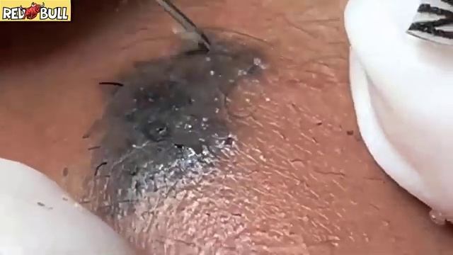 Чёрные и белые точки. Удаление. 𝟗𝟎𝟎𝟑𝟖𝟑 #черныеточки #чисткалица #проблемнаякожа