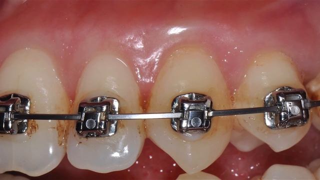 Хирургическое лечение рецессии десны 4.2