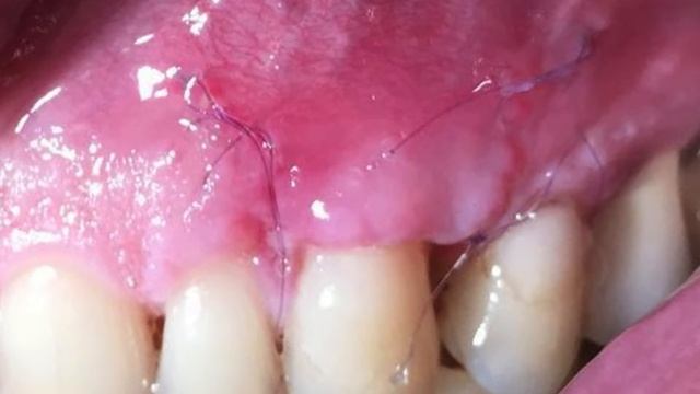 Хирургическое лечение рецессии десны 2.3