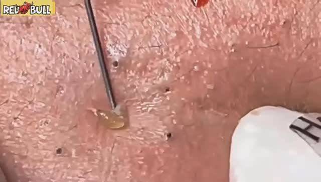 Прыщ, который заставил меня ахнуть. Самый необычный случай.𝟗𝟎𝟎𝟑𝟖𝟗