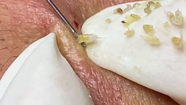 Relax Acne 009 • АСМР • Loan Nguyen collection