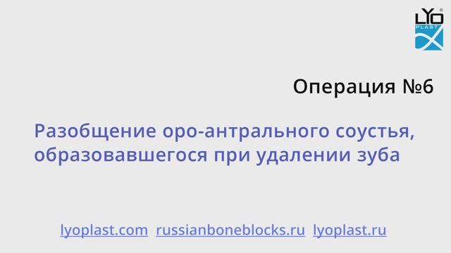 Операция №6 Разобщение оро-антрального соустья, образовавшегося при удалении зуба